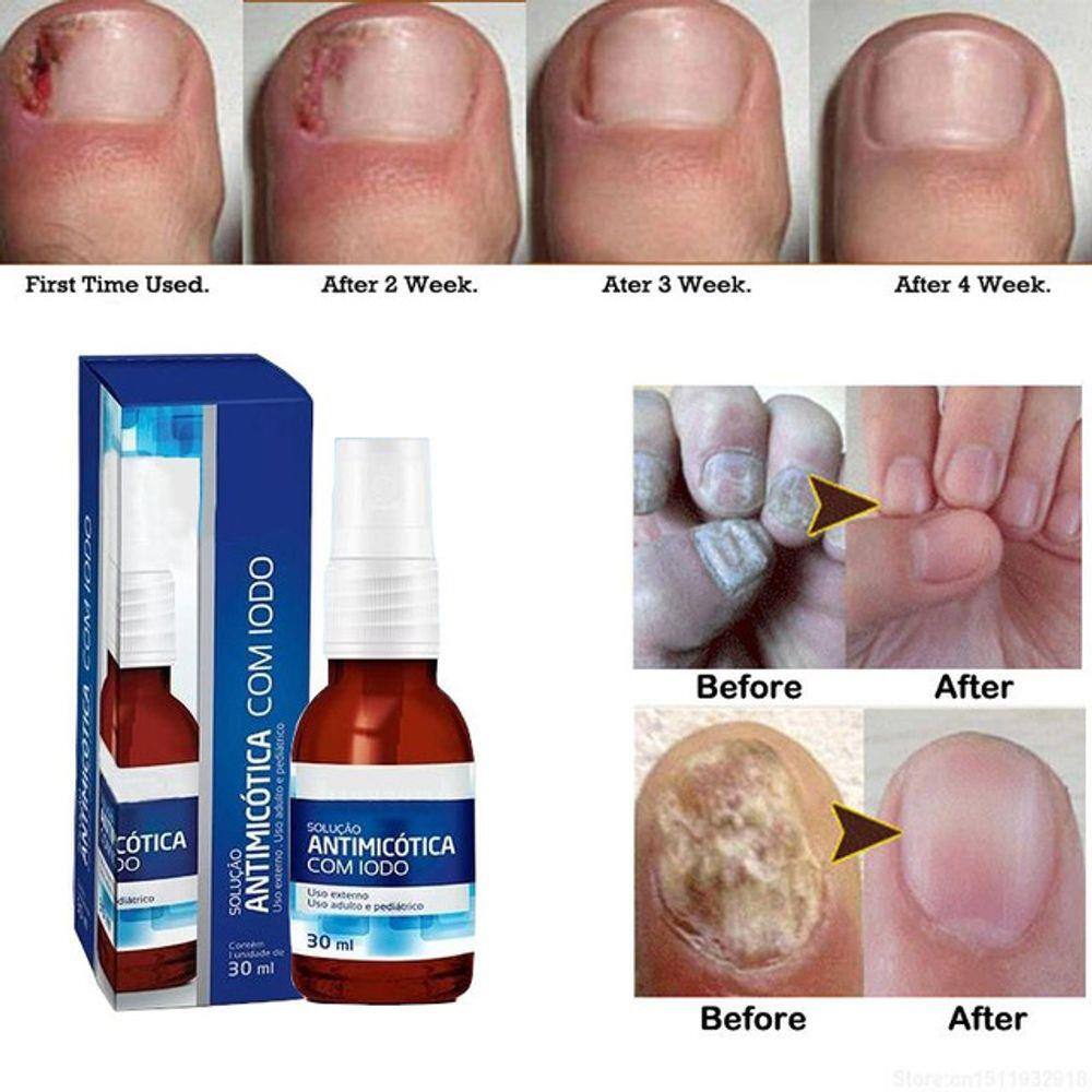 Pomada micose impinge | Pontofrio